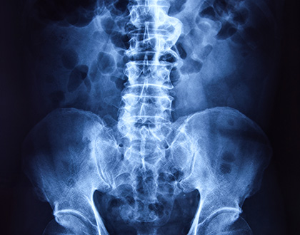 Back Injuries After Car Accidents: Here's What You Need to Know